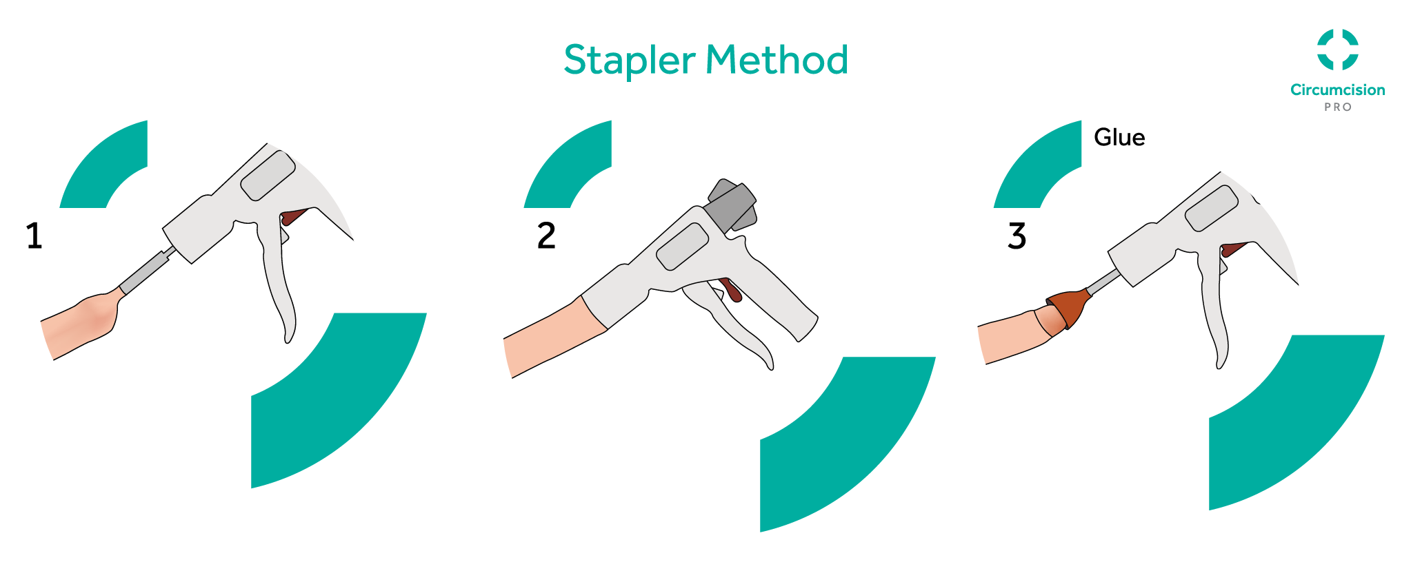 Adult Circumcision in London | Circumcision Pro